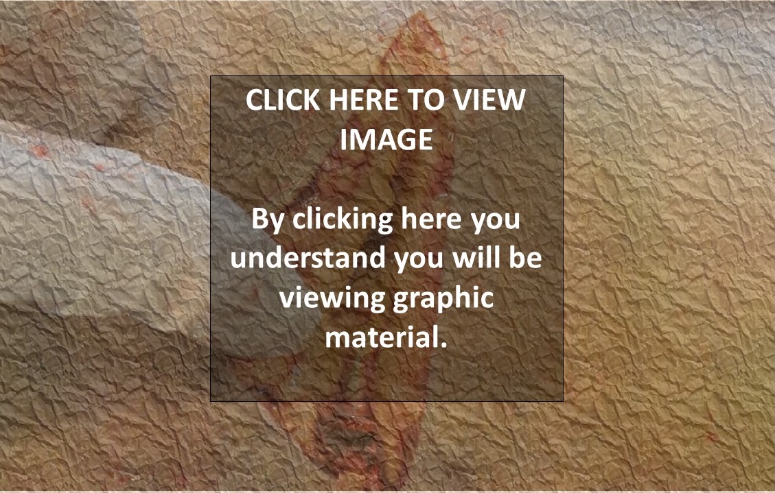 Childhood obesity – a public service announcement | Autopsy Center of ...